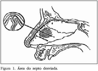 Endoscopic Septoplasty