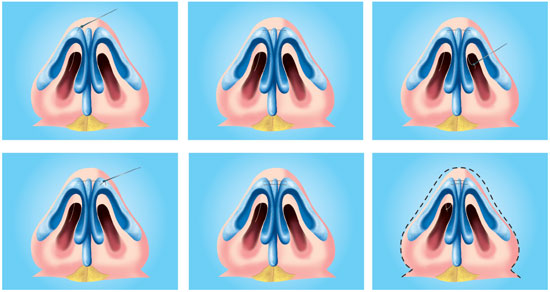 Nose tip refinement using interdomal suture in caucasian nose